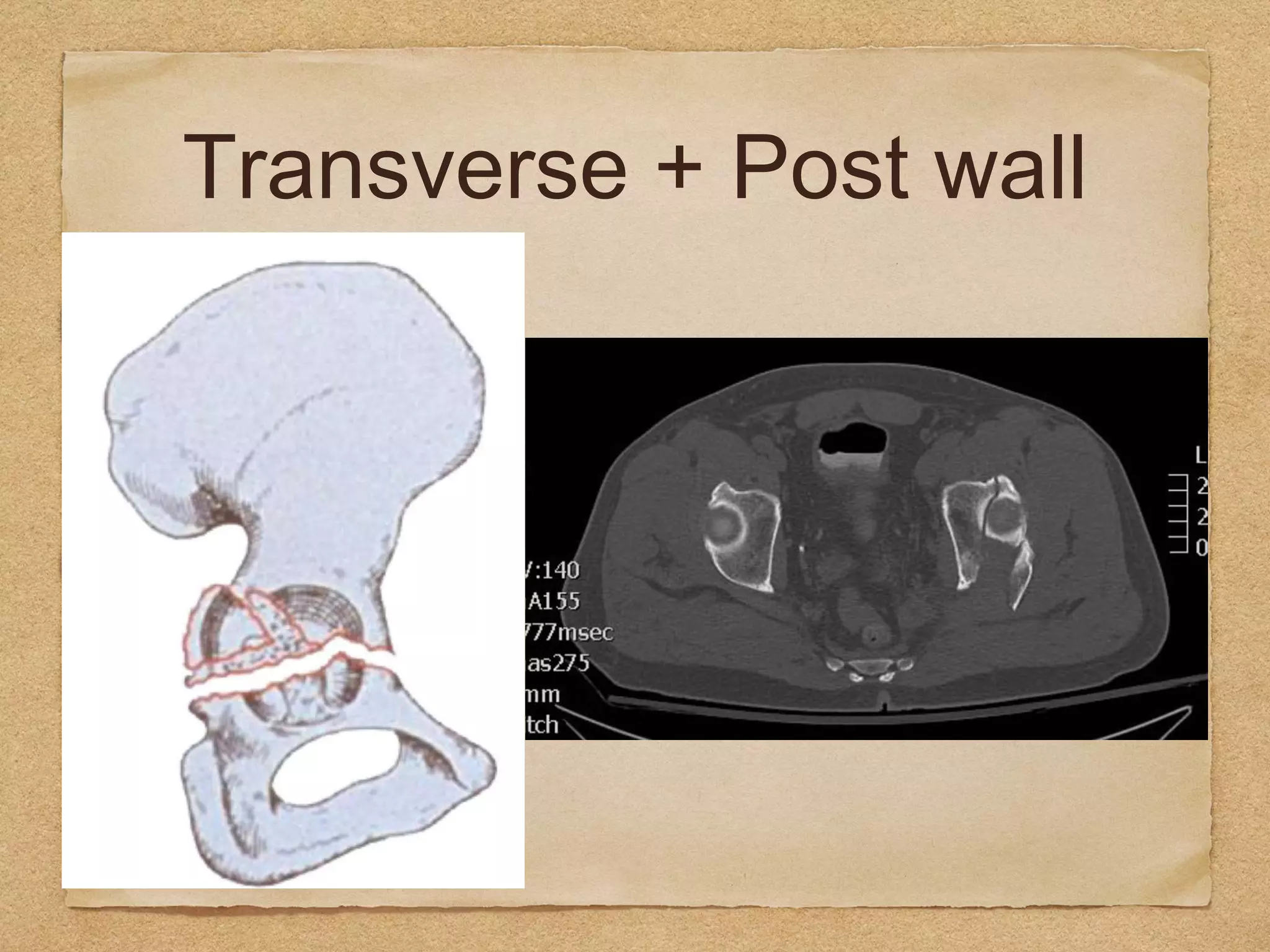 Acetabular Fracture Radiology: Xrays, CT scan & 3D printing | PPTX