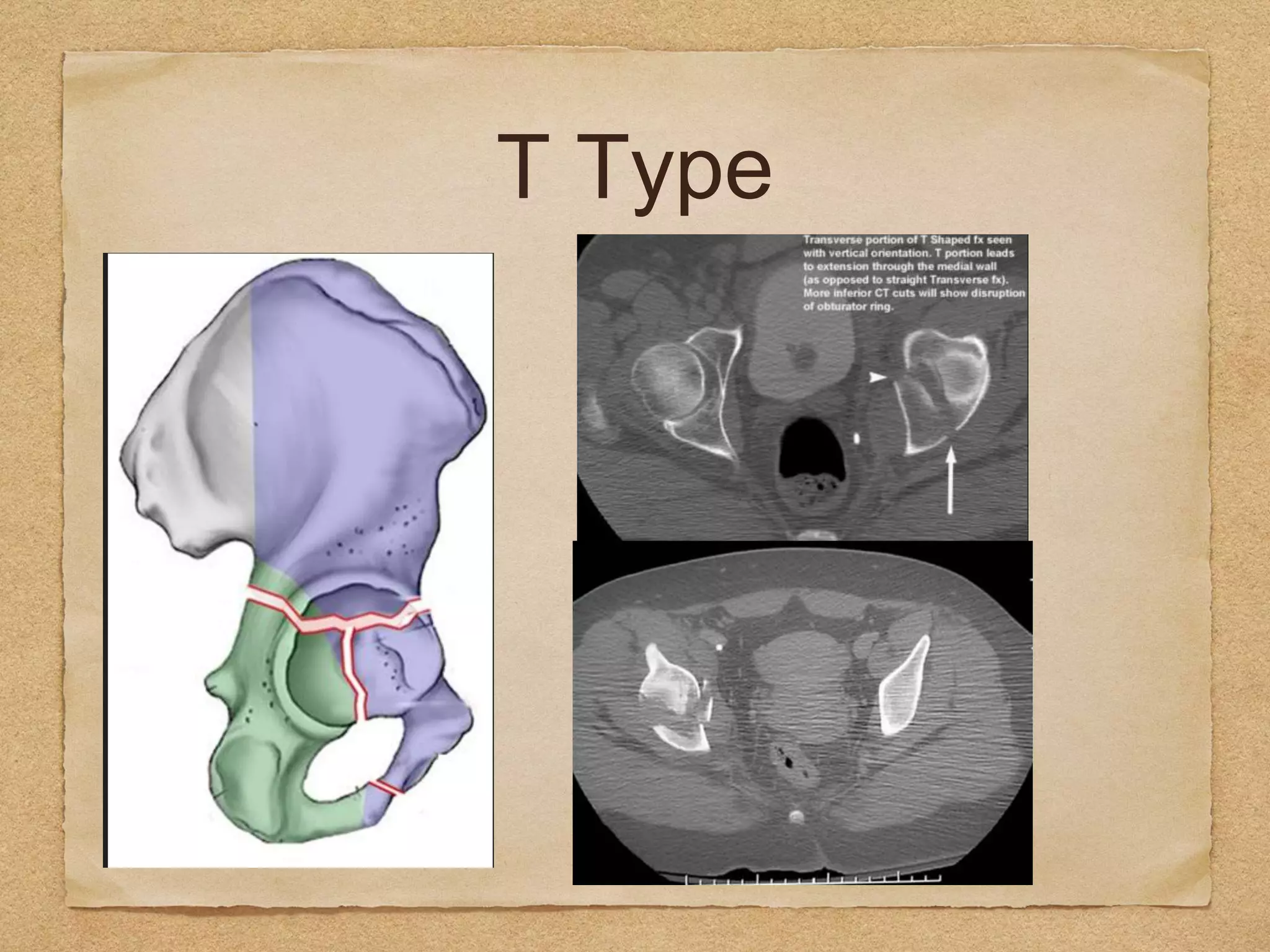 Acetabular Fracture Radiology: Xrays, CT scan & 3D printing | PPTX