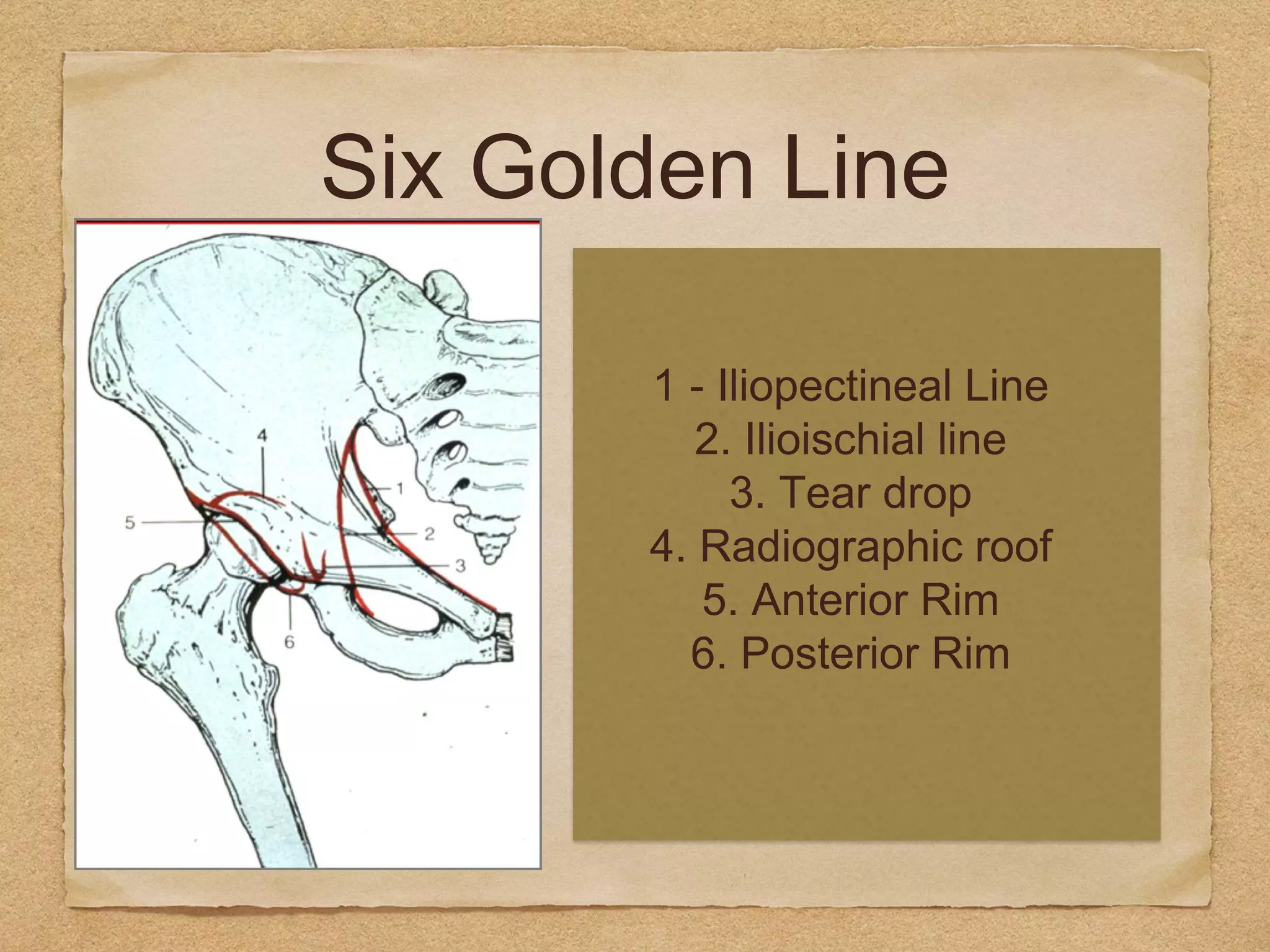 Acetabular Fracture Radiology: Xrays, CT scan & 3D printing | PPTX