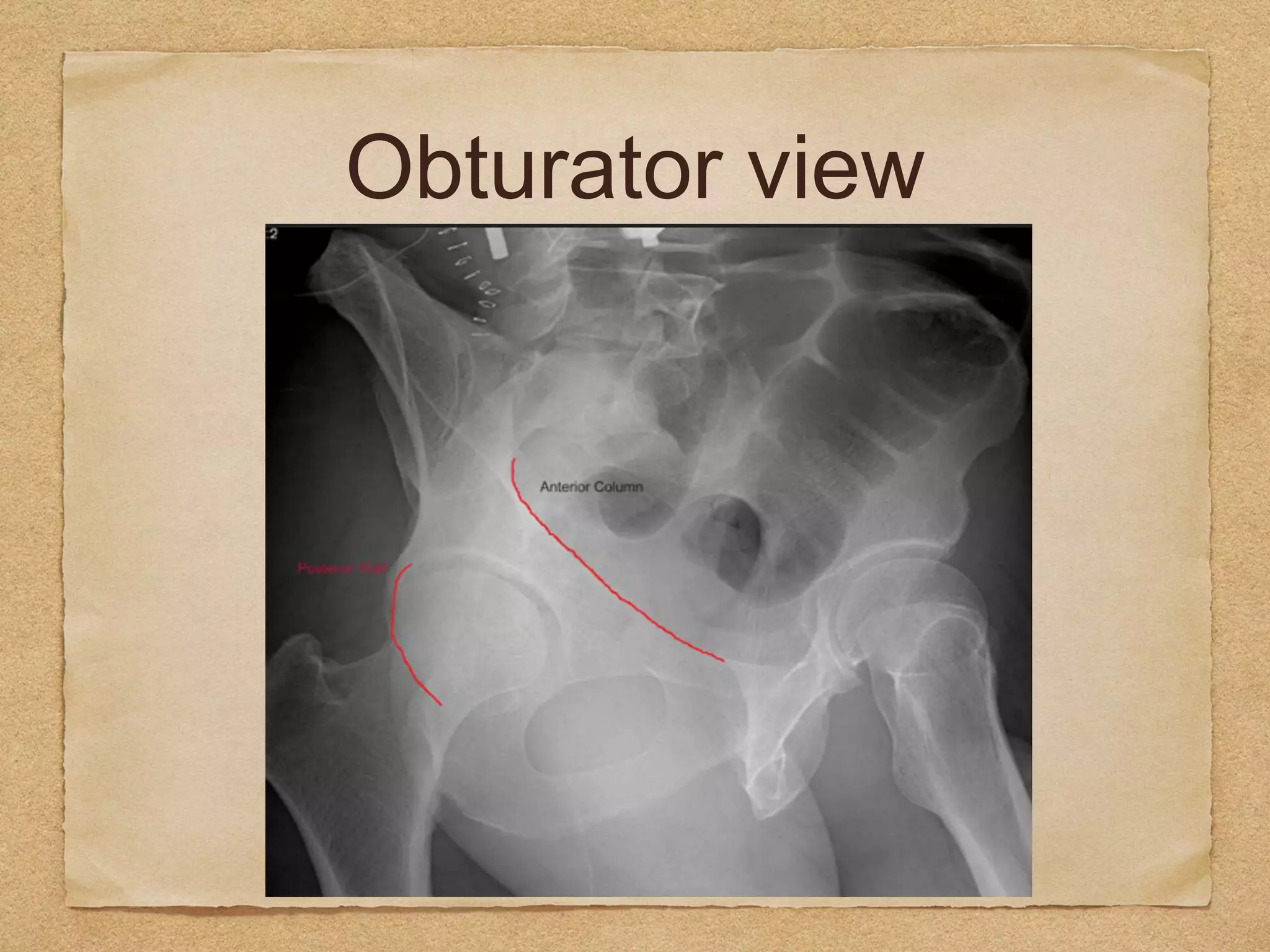 Acetabular Fracture Radiology: Xrays, CT scan & 3D printing | PPTX