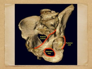 Acetabular Fracture Radiology: Xrays, CT scan & 3D printing | PPTX