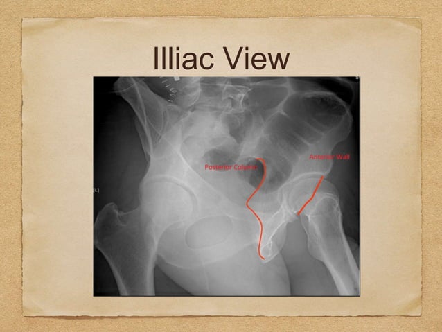 Acetabular Fracture Radiology: Xrays, CT scan & 3D printing | PPTX