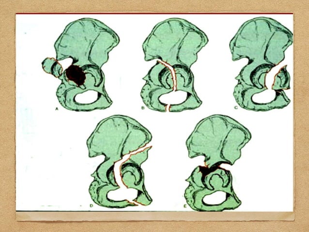 Acetabular Fracture Radiology: Xrays, CT scan & 3D printing | PPTX