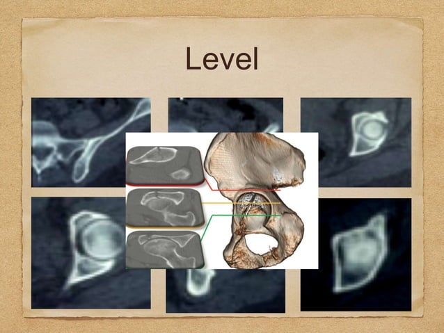 Acetabular Fracture Radiology: Xrays, CT scan & 3D printing | PPTX