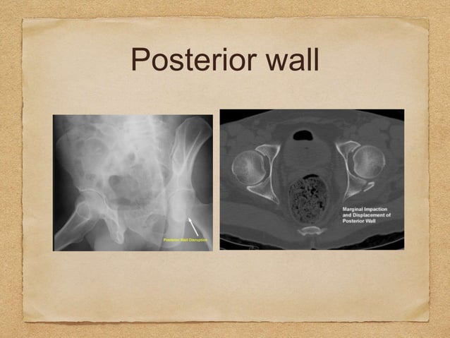 Acetabular Fracture Radiology: Xrays, CT scan & 3D printing | PPTX