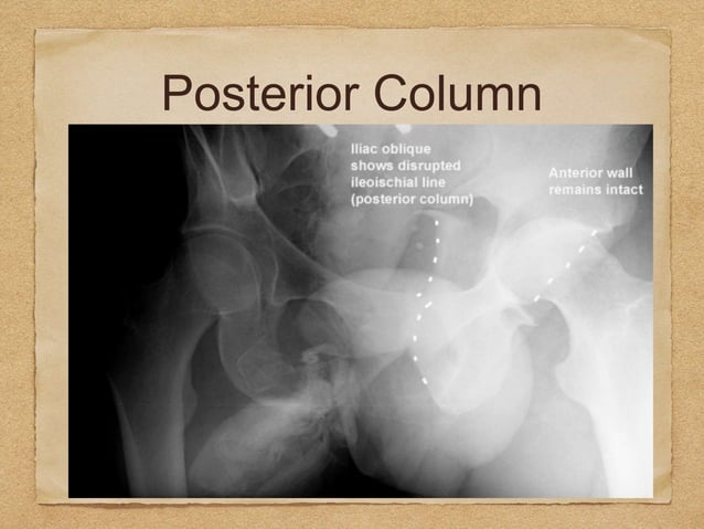Acetabular Fracture Radiology: Xrays, CT scan & 3D printing | PPTX