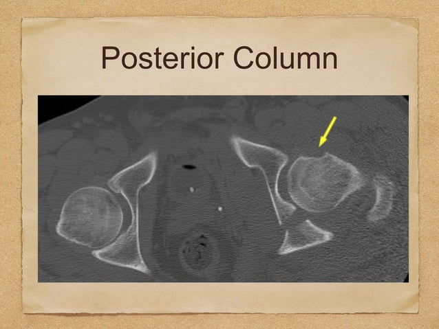 Acetabular Fracture Radiology: Xrays, CT scan & 3D printing | PPTX