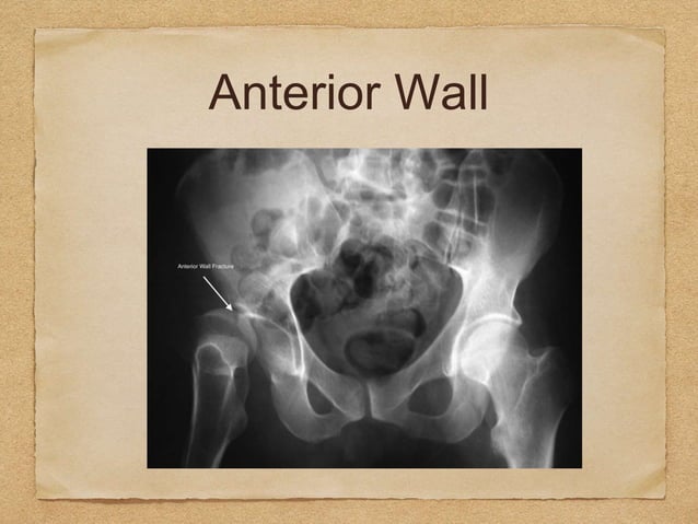 Acetabular Fracture Radiology Xrays Ct Scan And 3d Printing Pptx