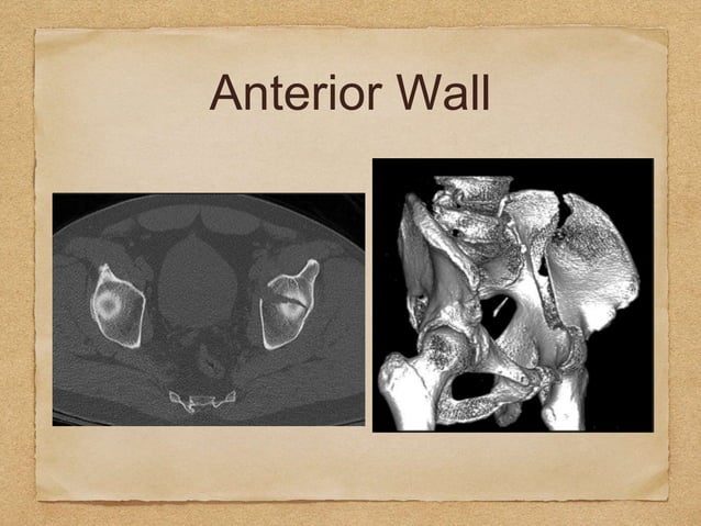 Acetabular Fracture Radiology: Xrays, CT scan & 3D printing | PPTX