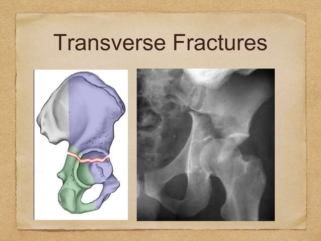 Acetabular Fracture Radiology: Xrays, CT scan & 3D printing | PPTX