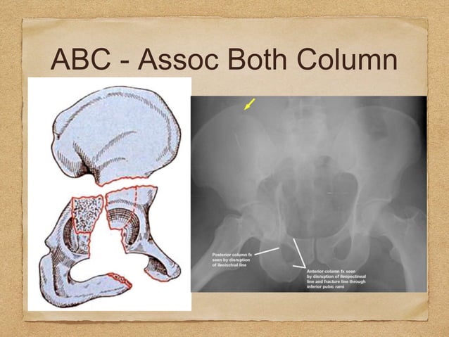 Acetabular Fracture Radiology: Xrays, CT scan & 3D printing | PPTX