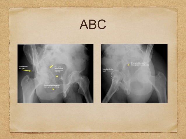 Acetabular Fracture Radiology: Xrays, CT scan & 3D printing | PPTX