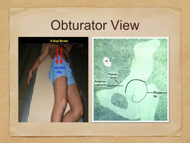Acetabular Fracture Radiology Xrays Ct Scan And 3d Printing Pptx