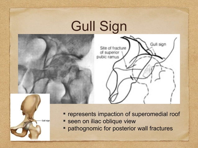 Acetabular Fracture Radiology: Xrays, CT scan & 3D printing | PPT
