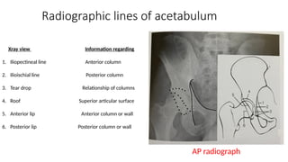 Acetabular Fractures-anatomy, classification s.pptx