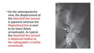 Acetabular Fractures-anatomy, classification s.pptx