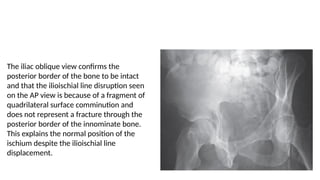 Acetabular Fractures-anatomy, classification s.pptx