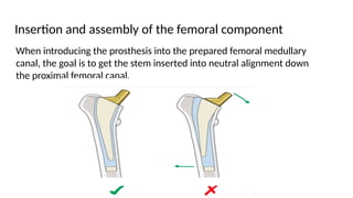 Acetabular Fractures-anatomy, classification s.pptx
