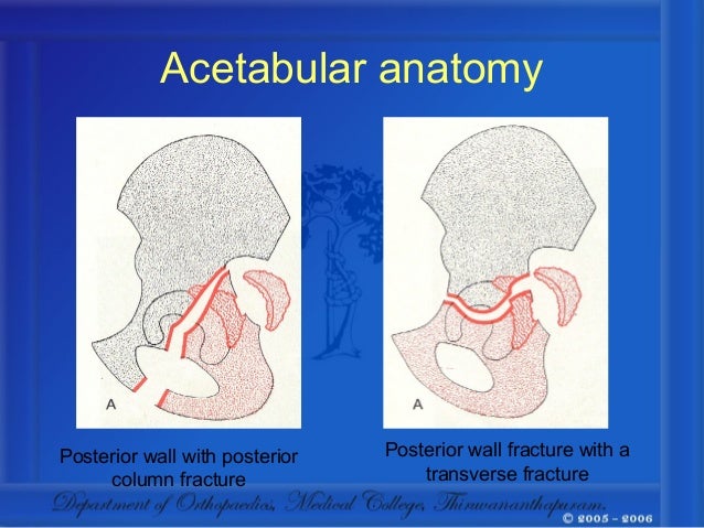 Acetabular fractures