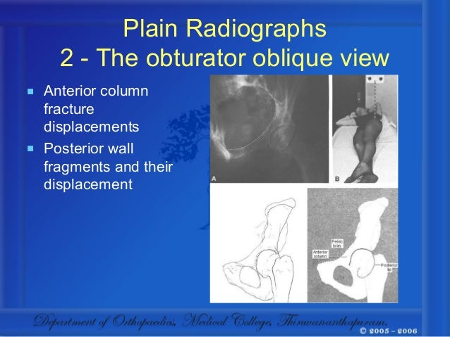 Acetabular fractures