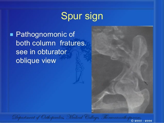 Acetabular fractures