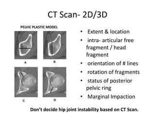 Acetabular fractures | PPTX