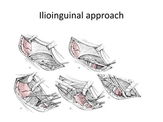 Acetabular fractures | PPTX