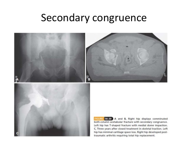 Acetabular fractures