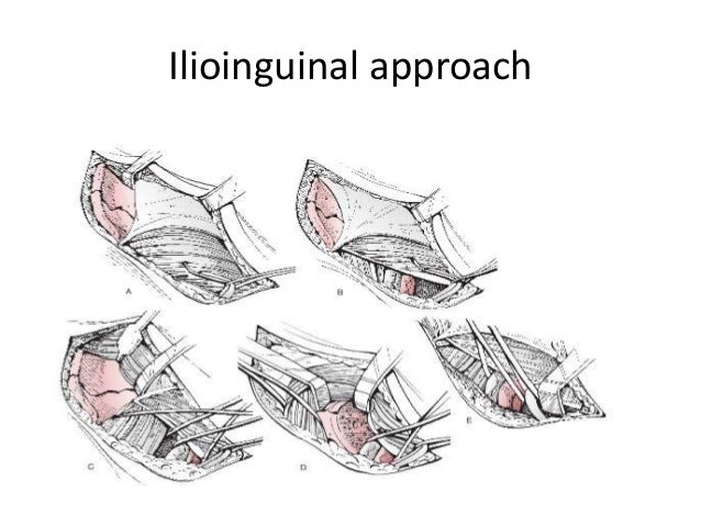 Acetabular fractures