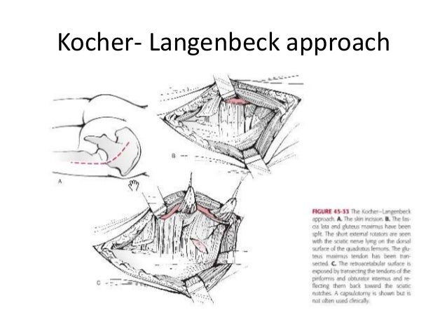 Acetabular fractures