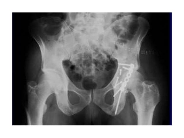 Acetabular fractures