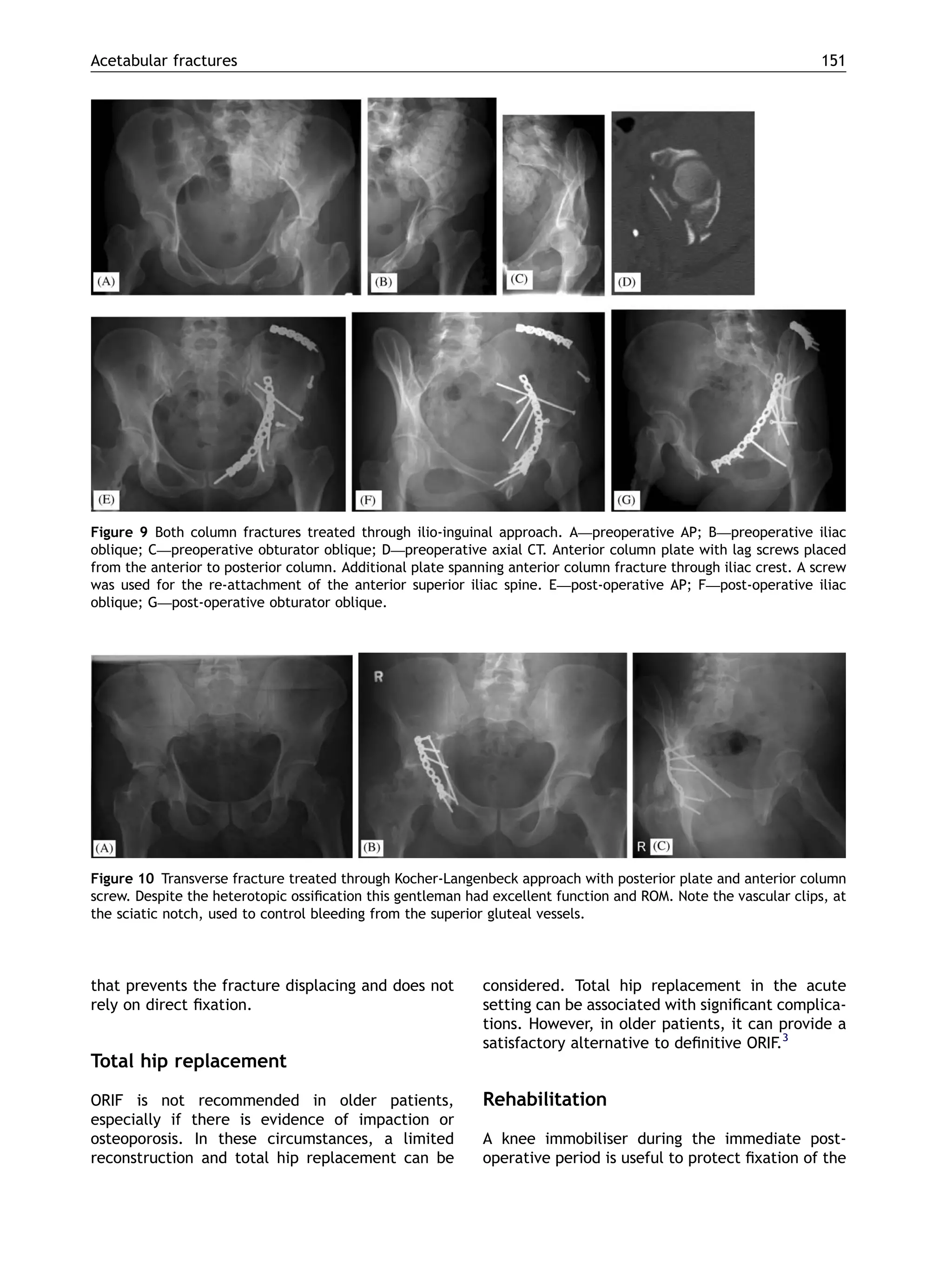 Acetabular fractures | PDF