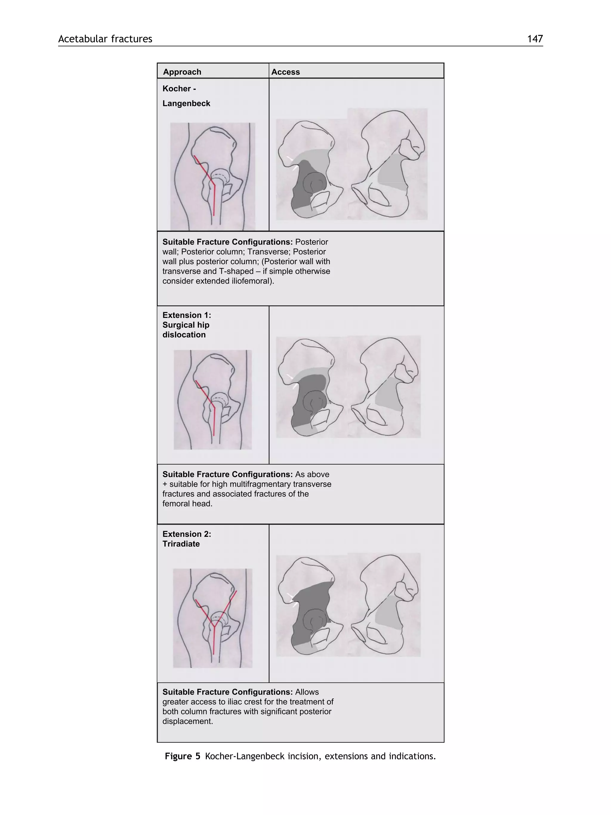 Acetabular fractures | PDF