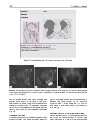 Acetabular fractures | PDF