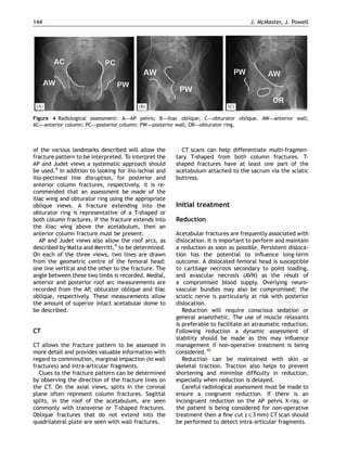 Acetabular fractures | PDF