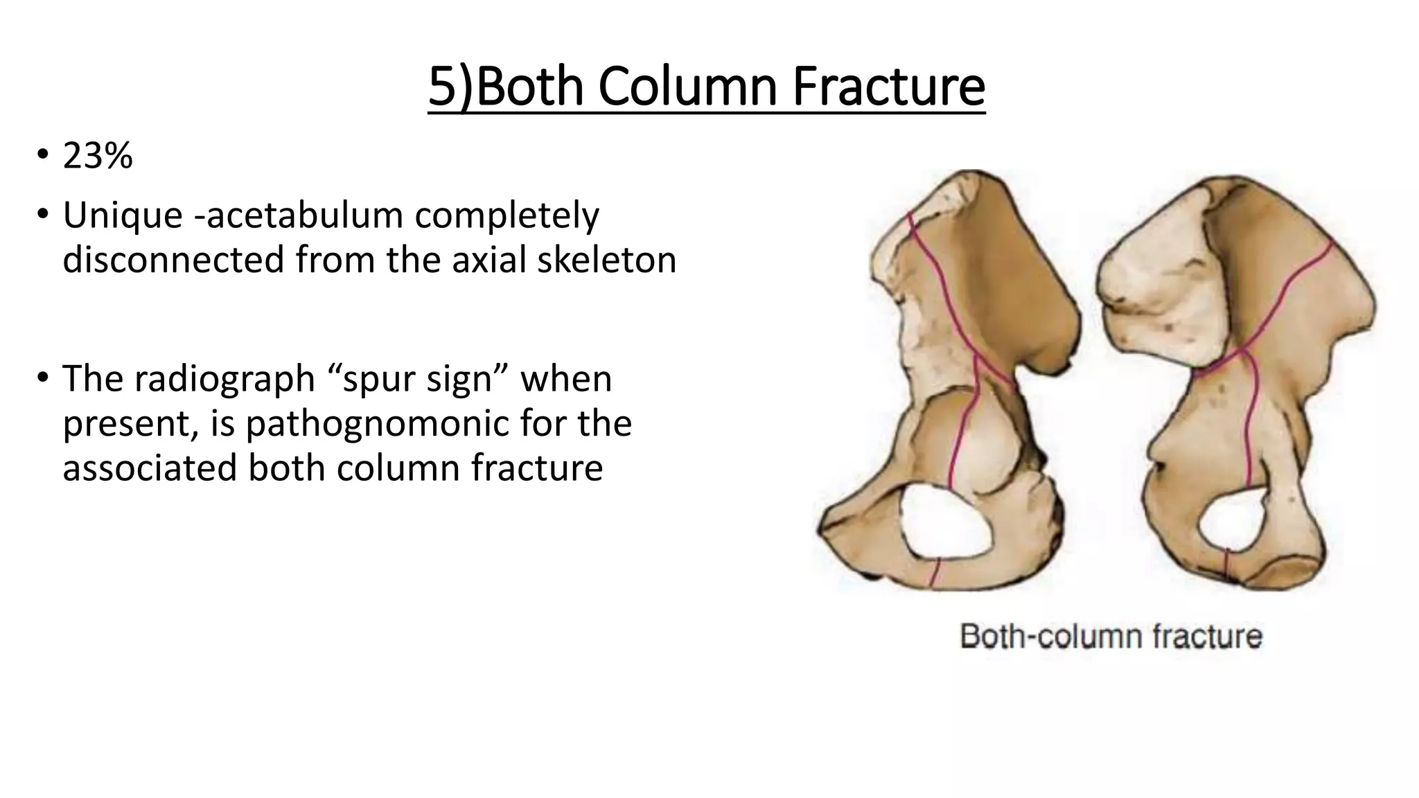 Acetabular fractures | PPTX