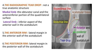 Acetabular fractures | PPTX