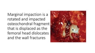 Acetabular fractures | PPTX