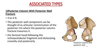 Acetabular fractures | PPTX