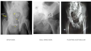 Acetabular fractures | PPTX