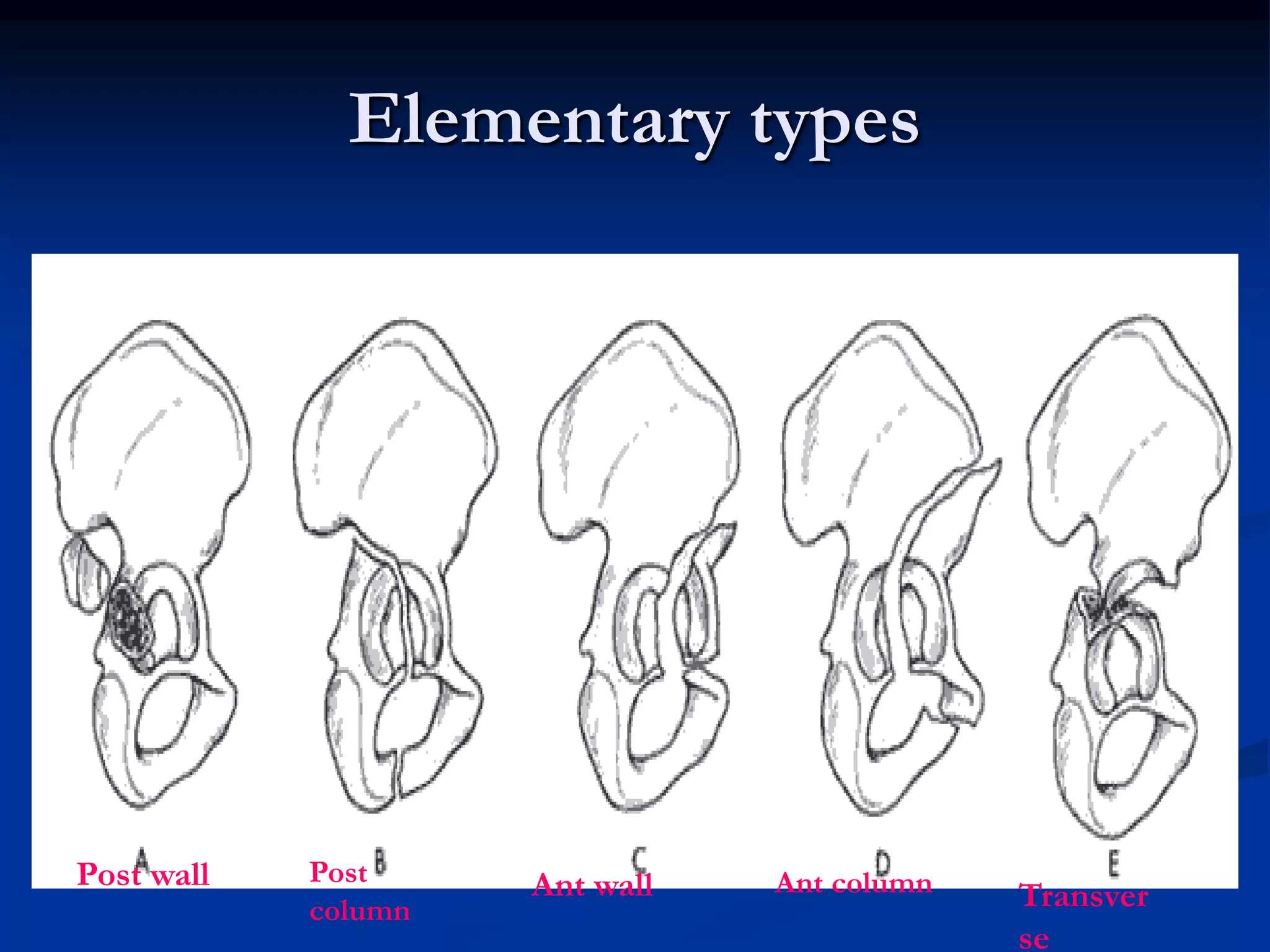 Acetabular fractures.ppt