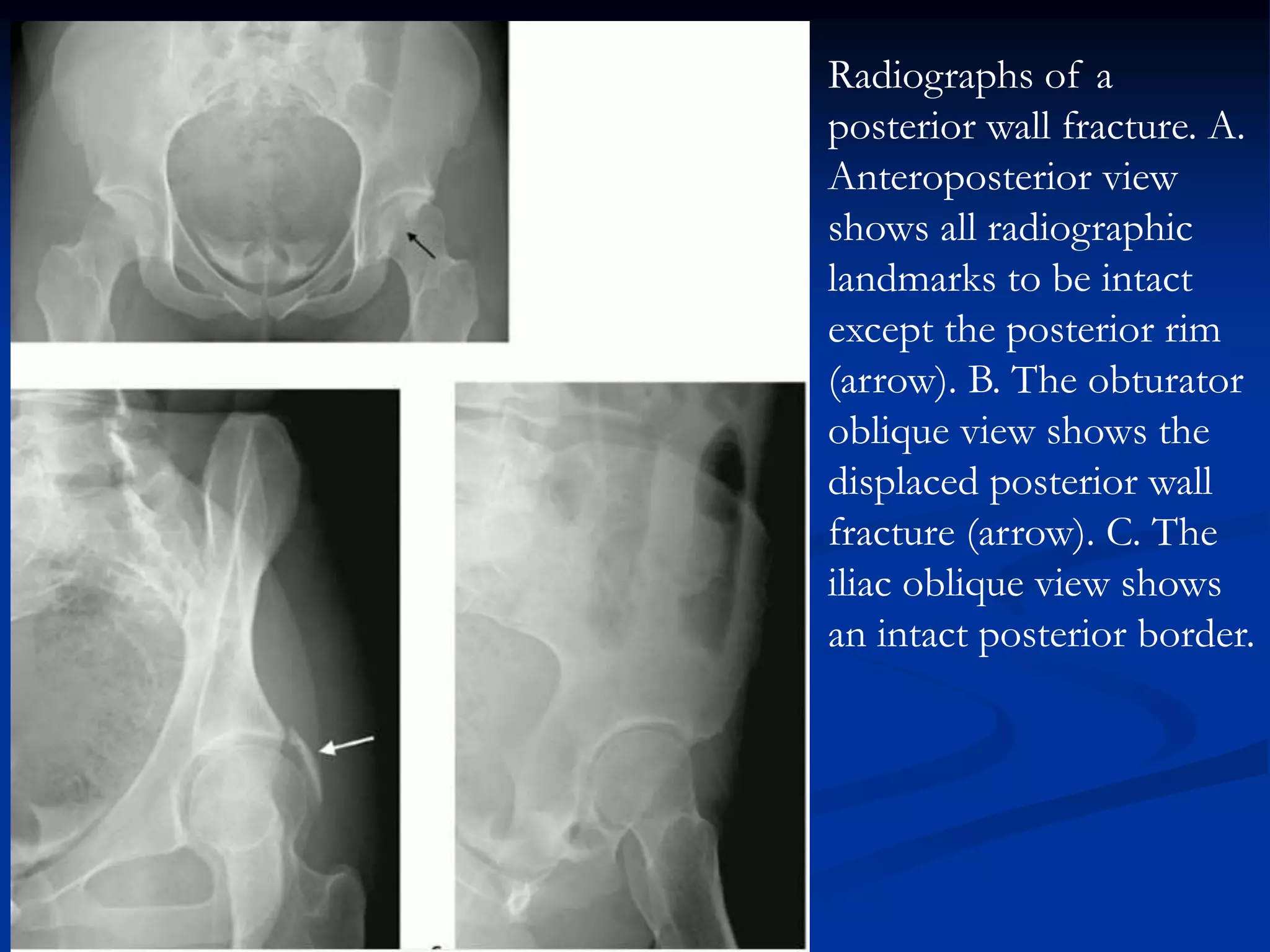 Acetabular fractures.ppt