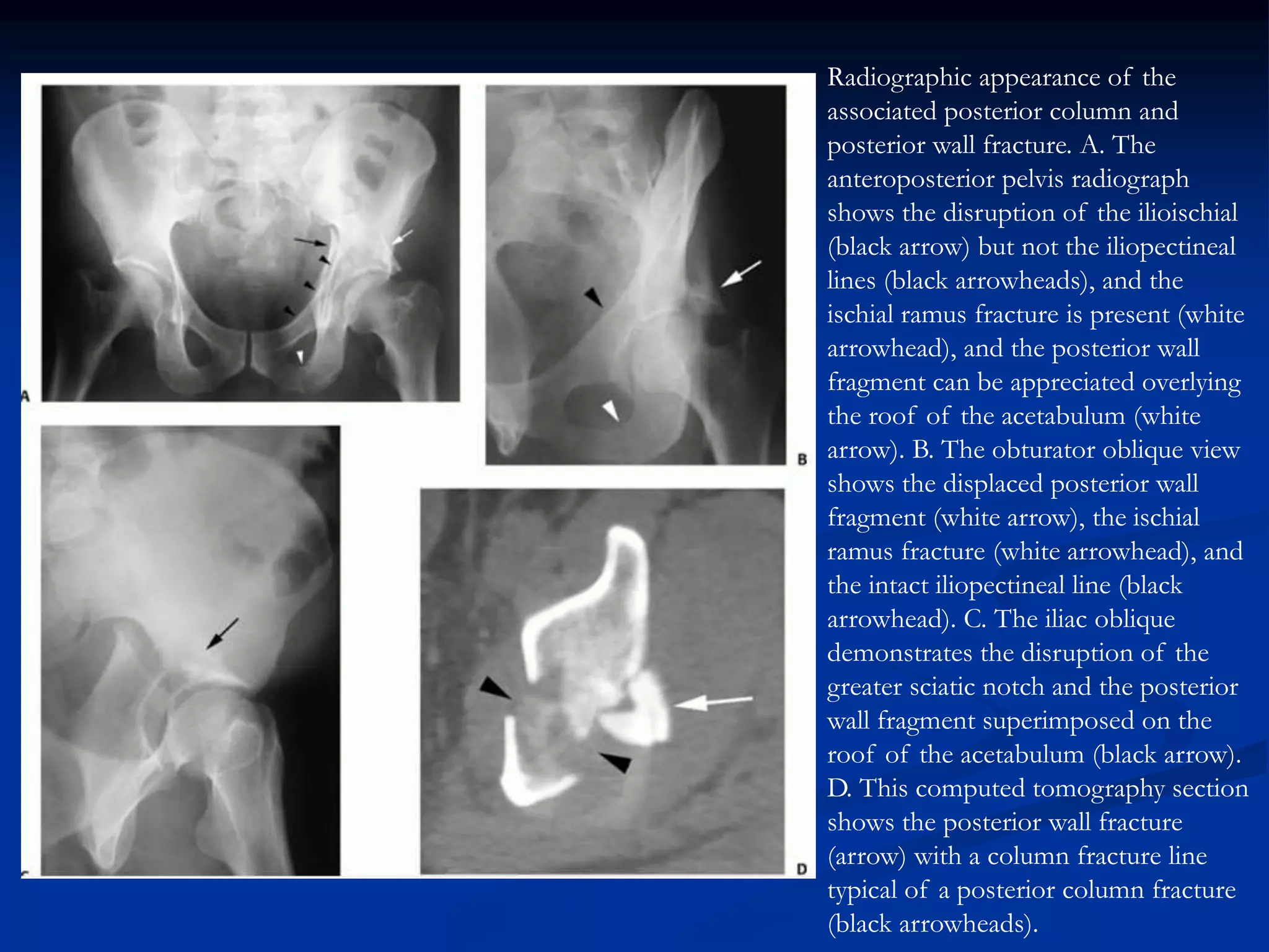 Acetabular fractures.ppt