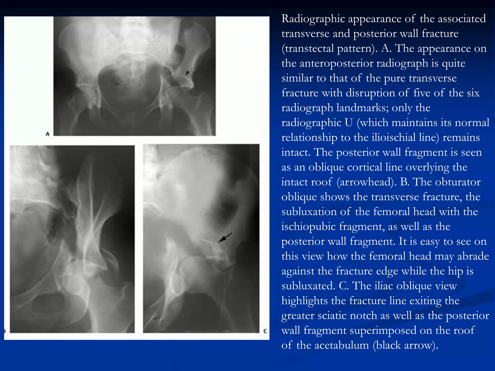 Acetabular fractures.ppt