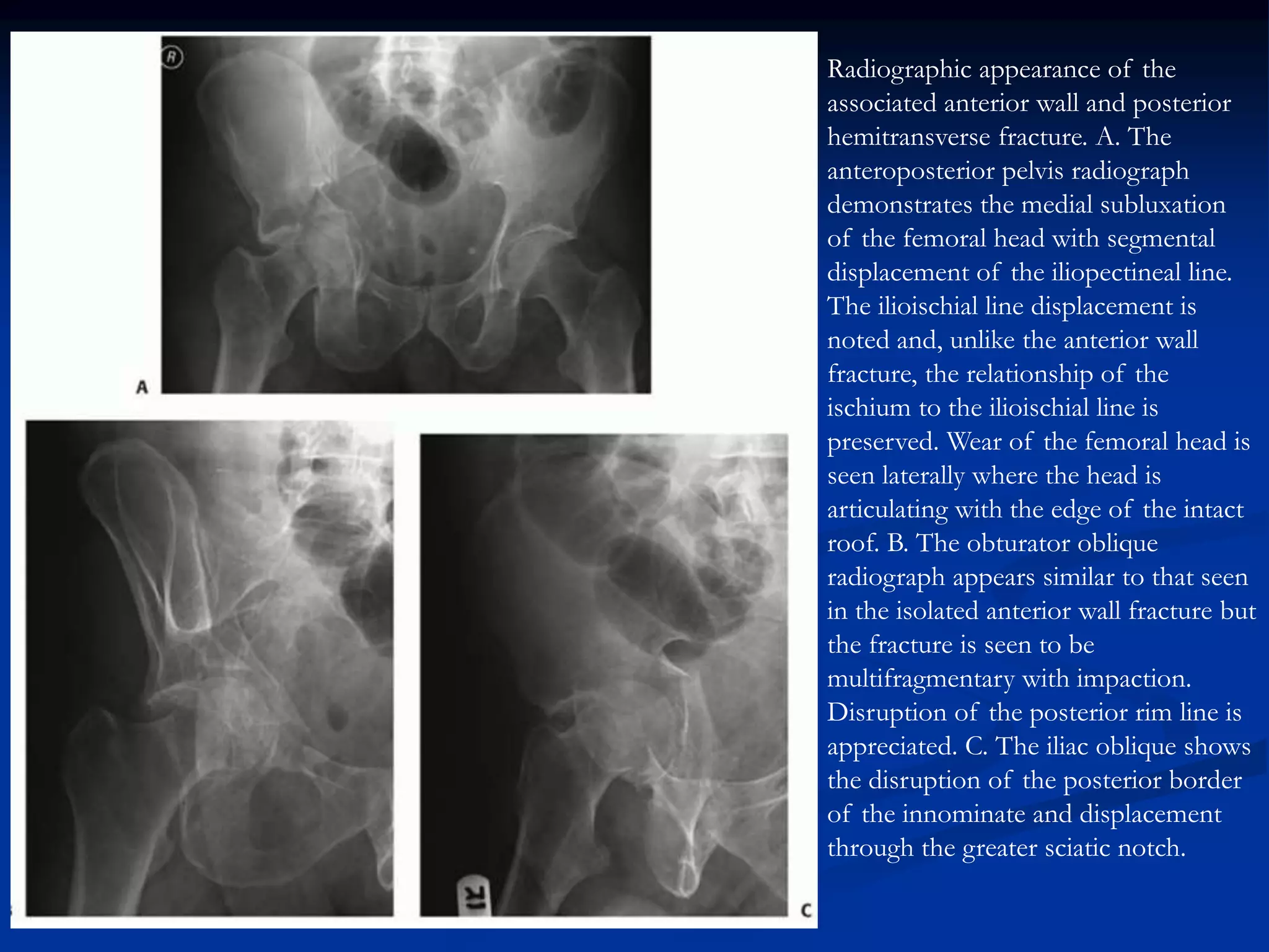 Acetabular fractures.ppt