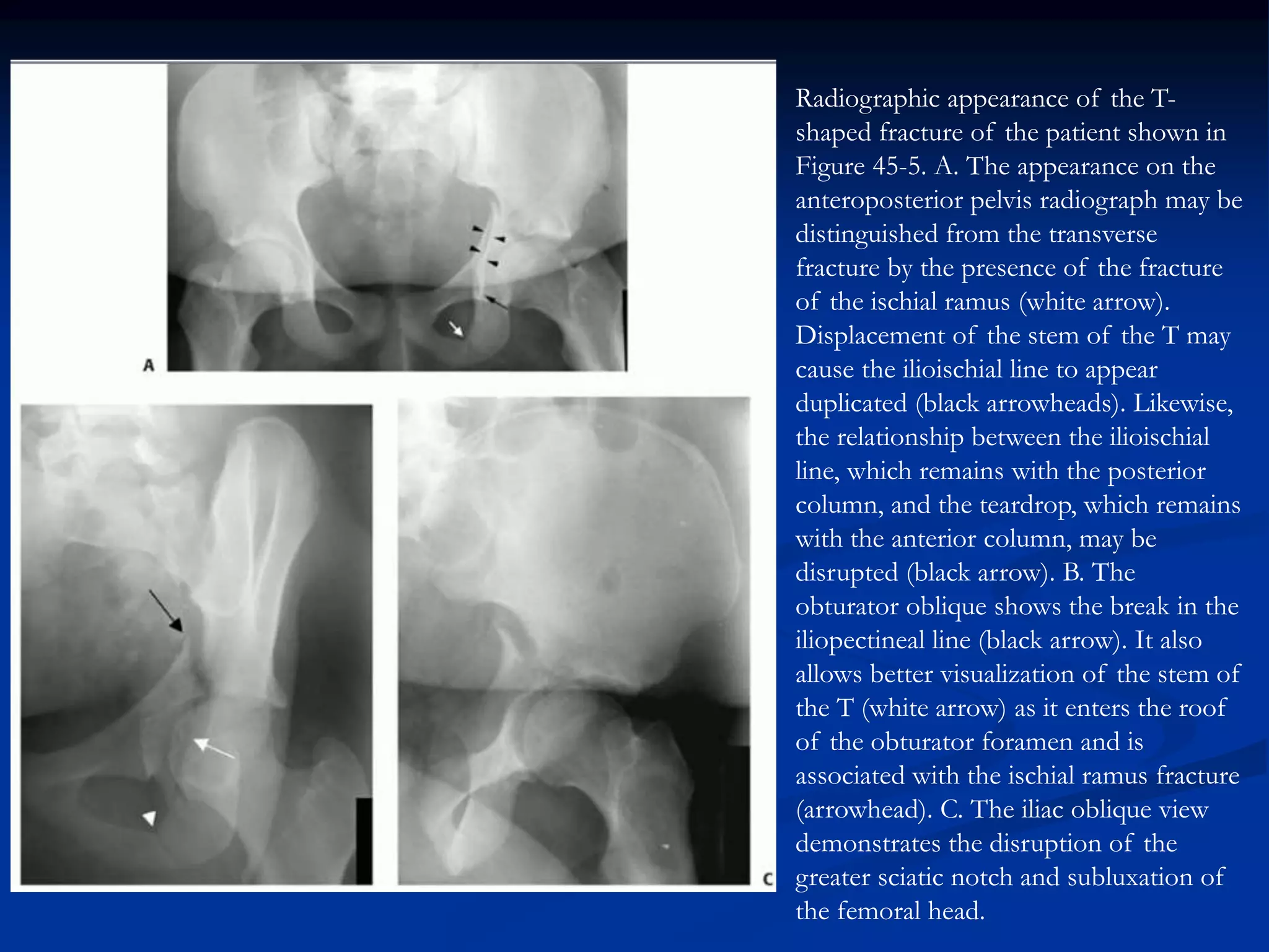 Acetabular fractures.ppt