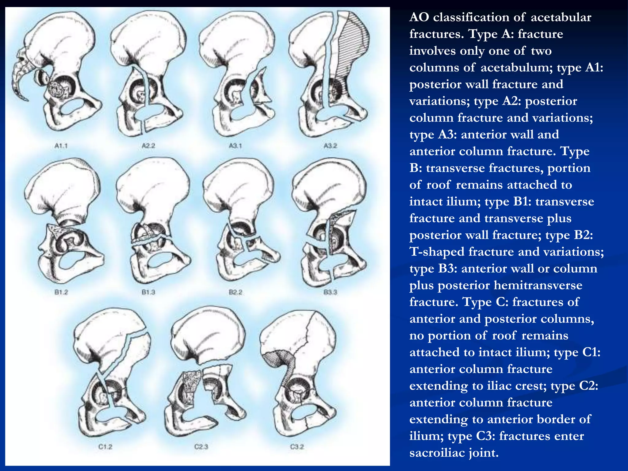Acetabular fractures.ppt