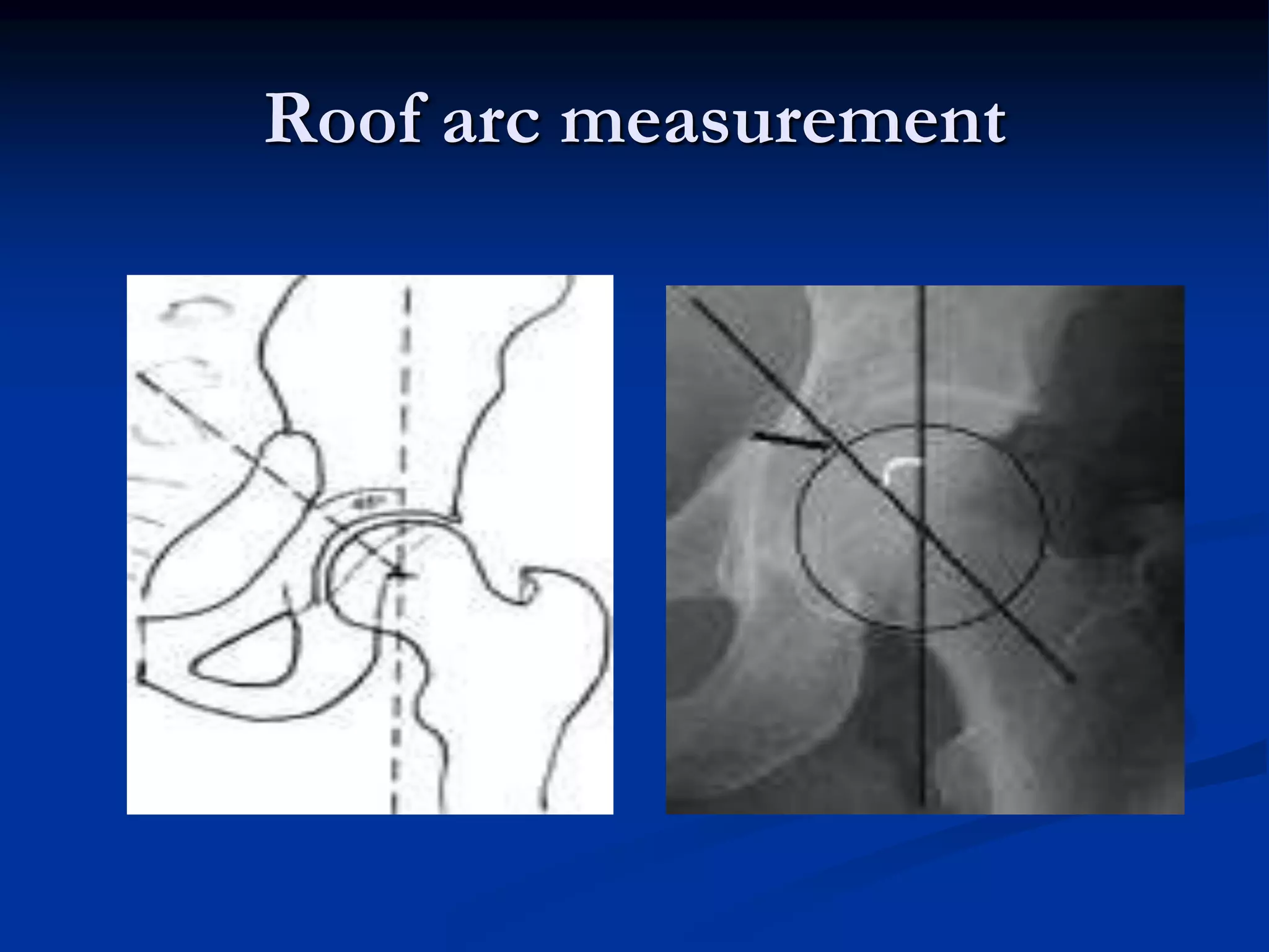 Acetabular fractures.ppt