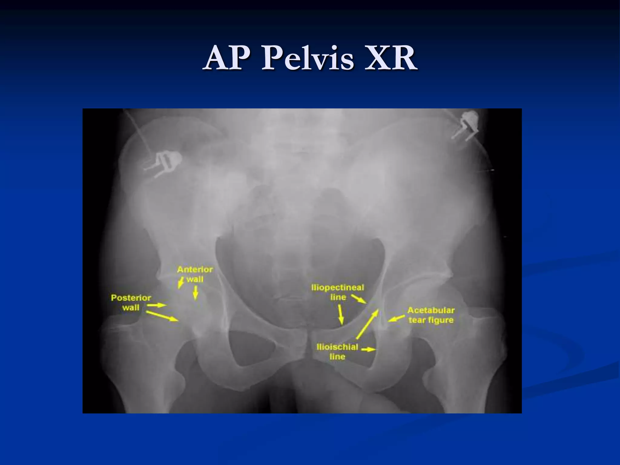 Acetabular fractures.ppt