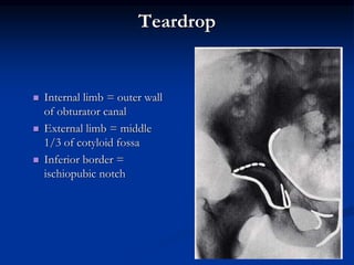 Acetabular fractures.ppt
